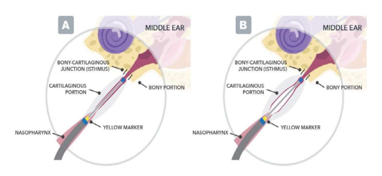 Eustachian Tube Dysfunction | Specialty Care Institute