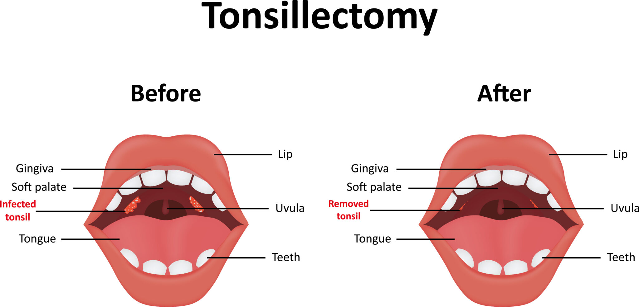 4 Signs You May Need a Tonsillectomy | Specialty Care Institute